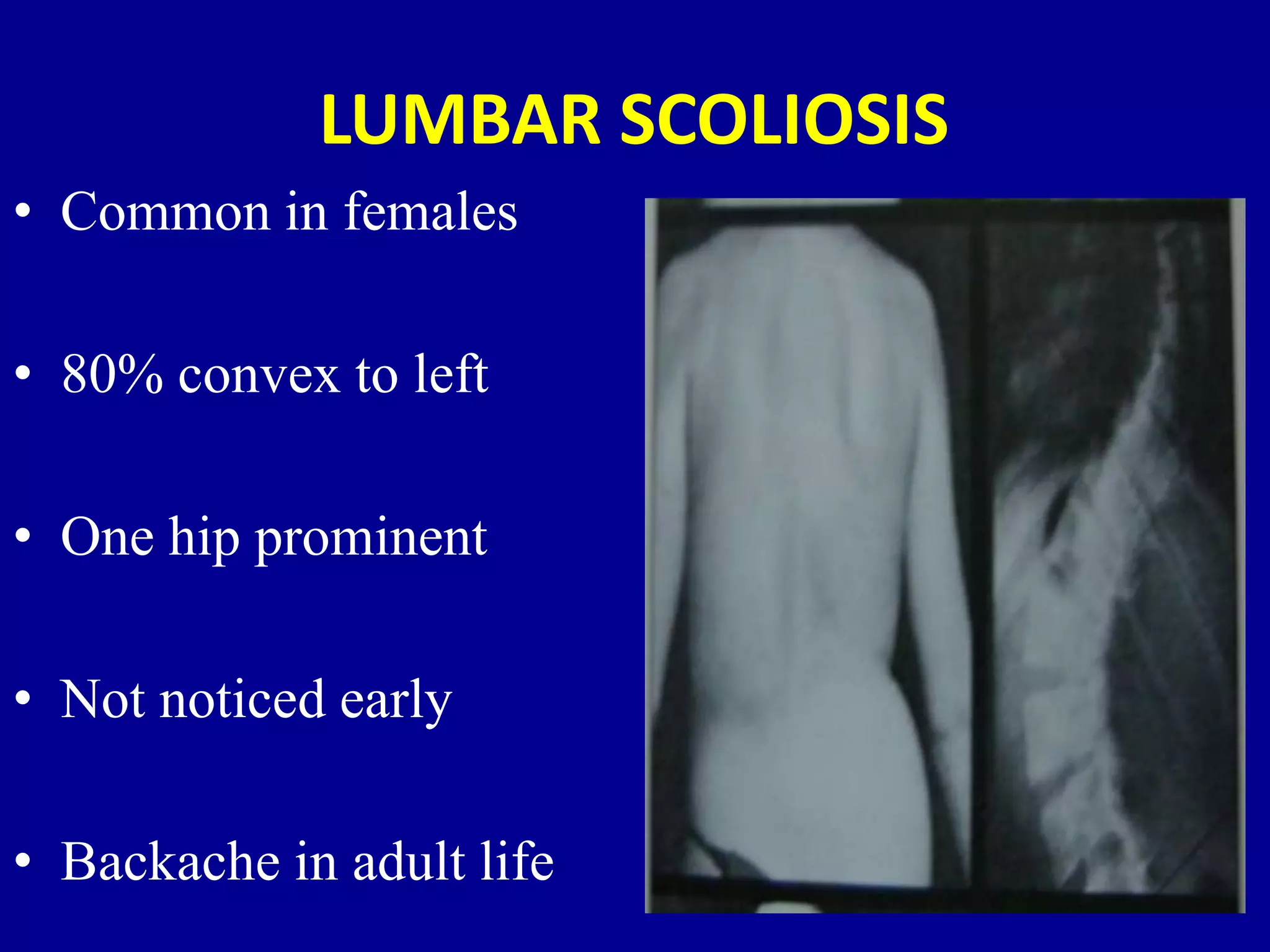Scoliosis | PPTX