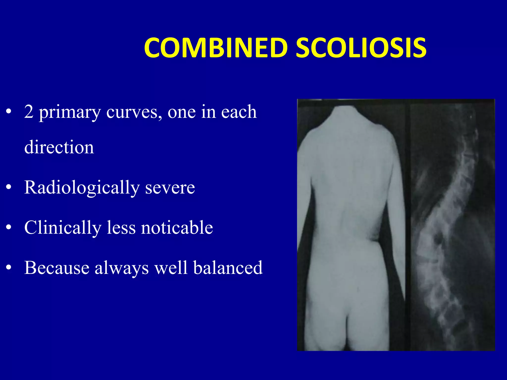 Scoliosis | PPTX