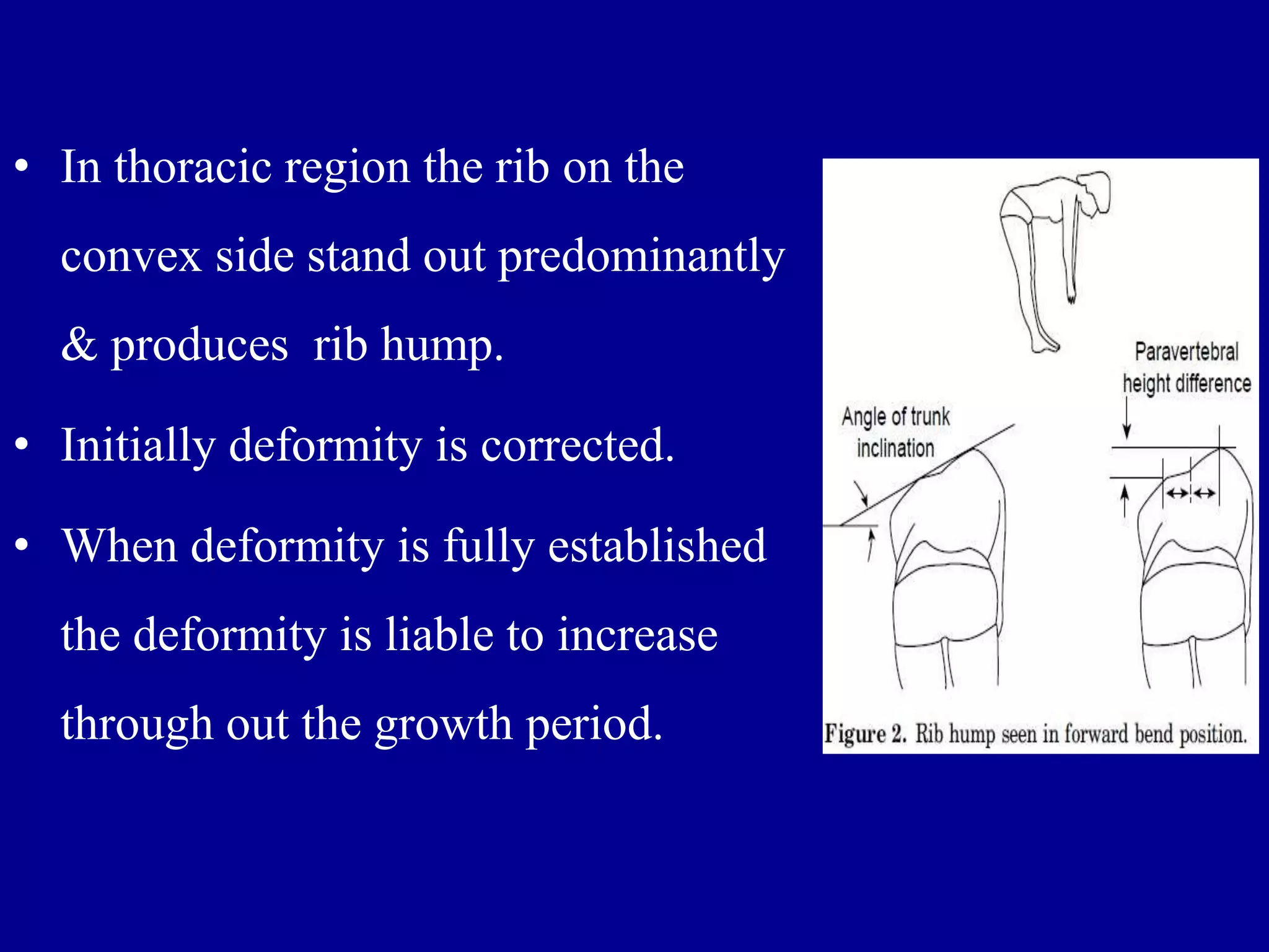 Scoliosis | PPTX
