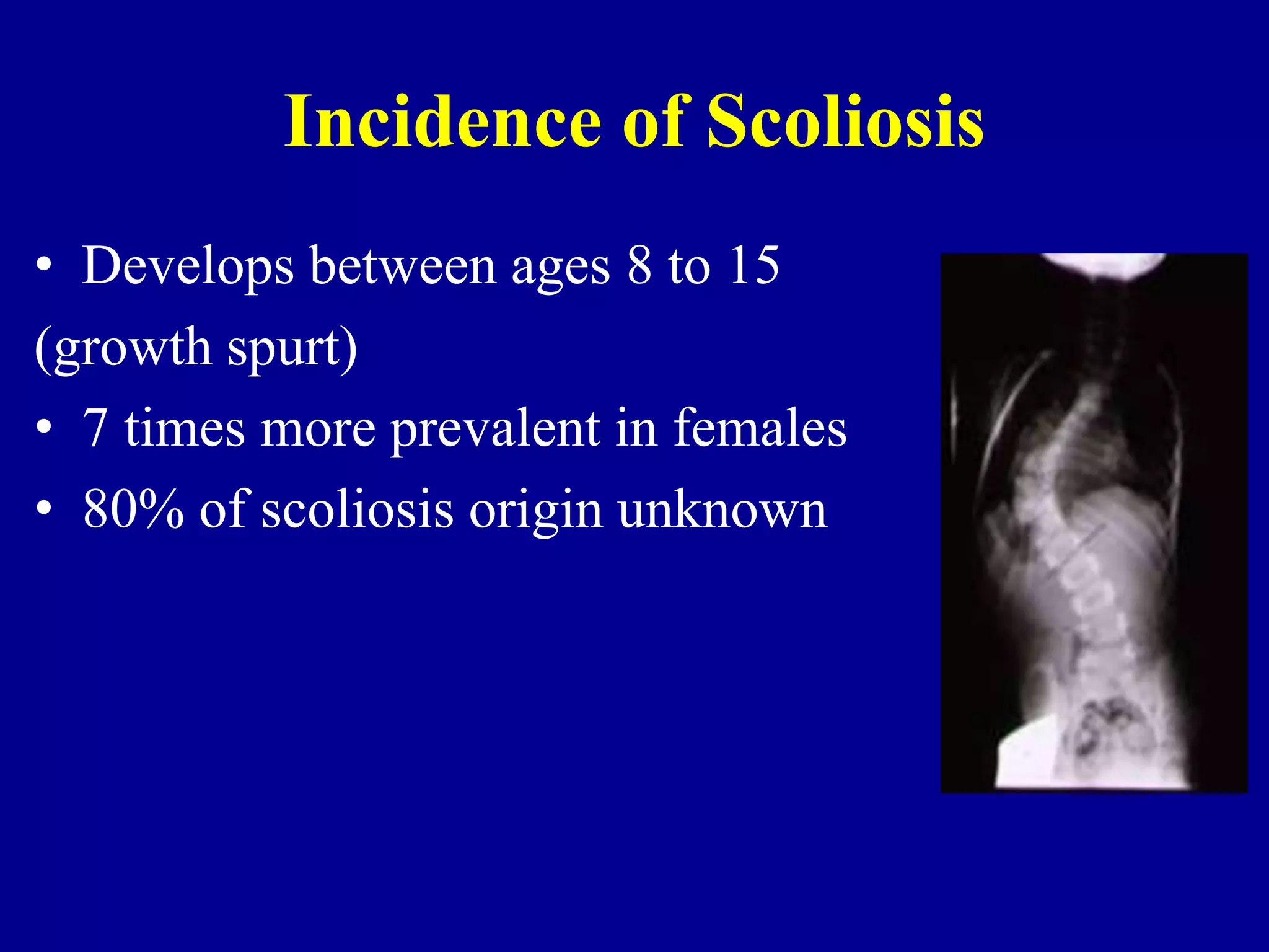 Scoliosis | PPTX