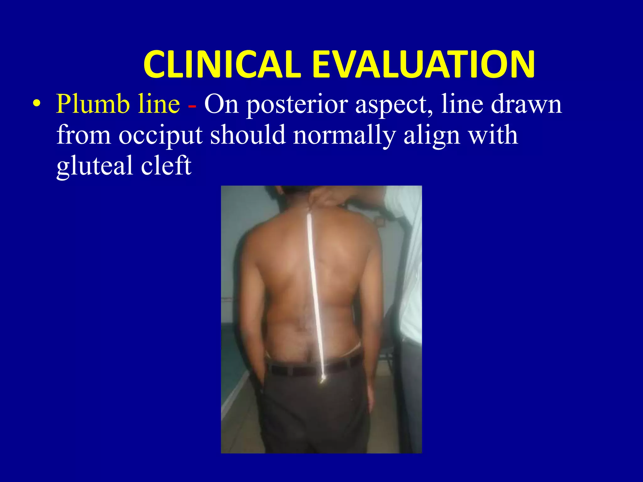 Scoliosis | PPTX