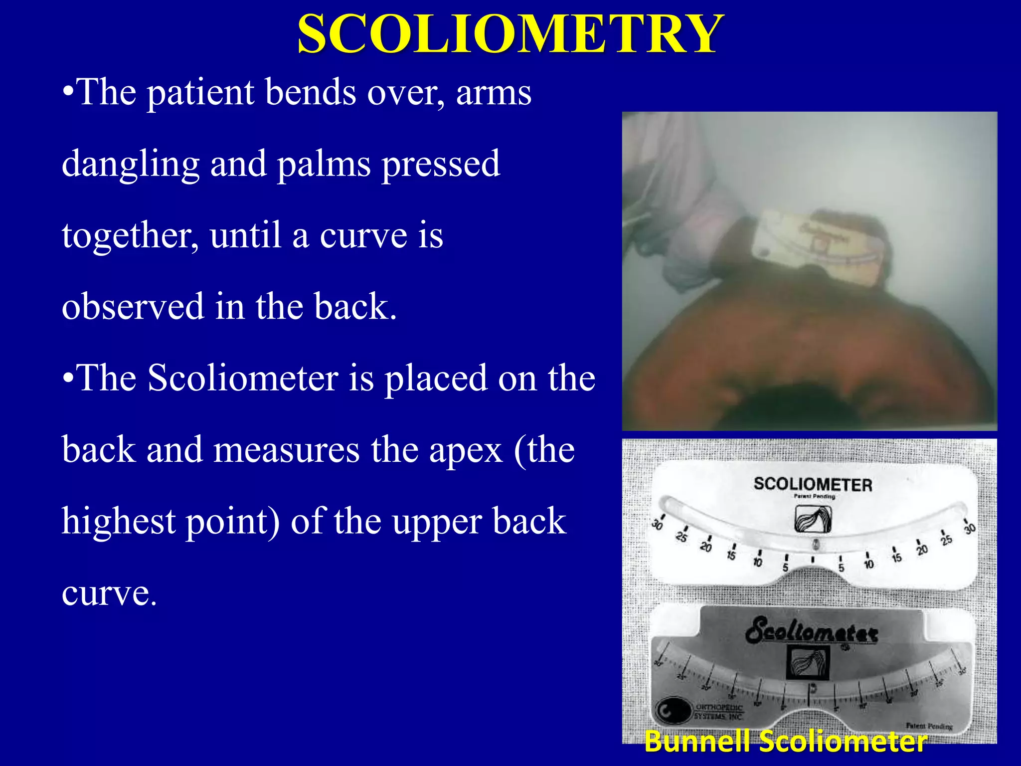 Scoliosis | PPTX
