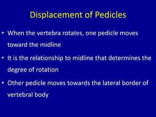 Scoliosis | PPTX