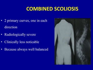 Concave Vs Convex Scoliosis