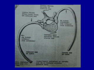 Concave Vs Convex Scoliosis