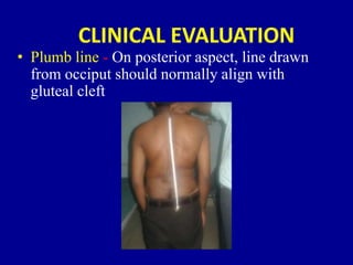 Plumb Line Scoliosis