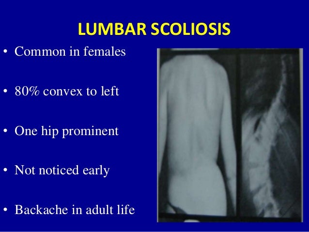 Scoliosis