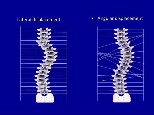paralytic and postural scoliosis