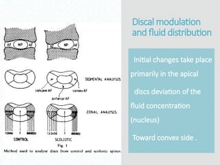 3 D management of lateral shift of the spine | PPTX