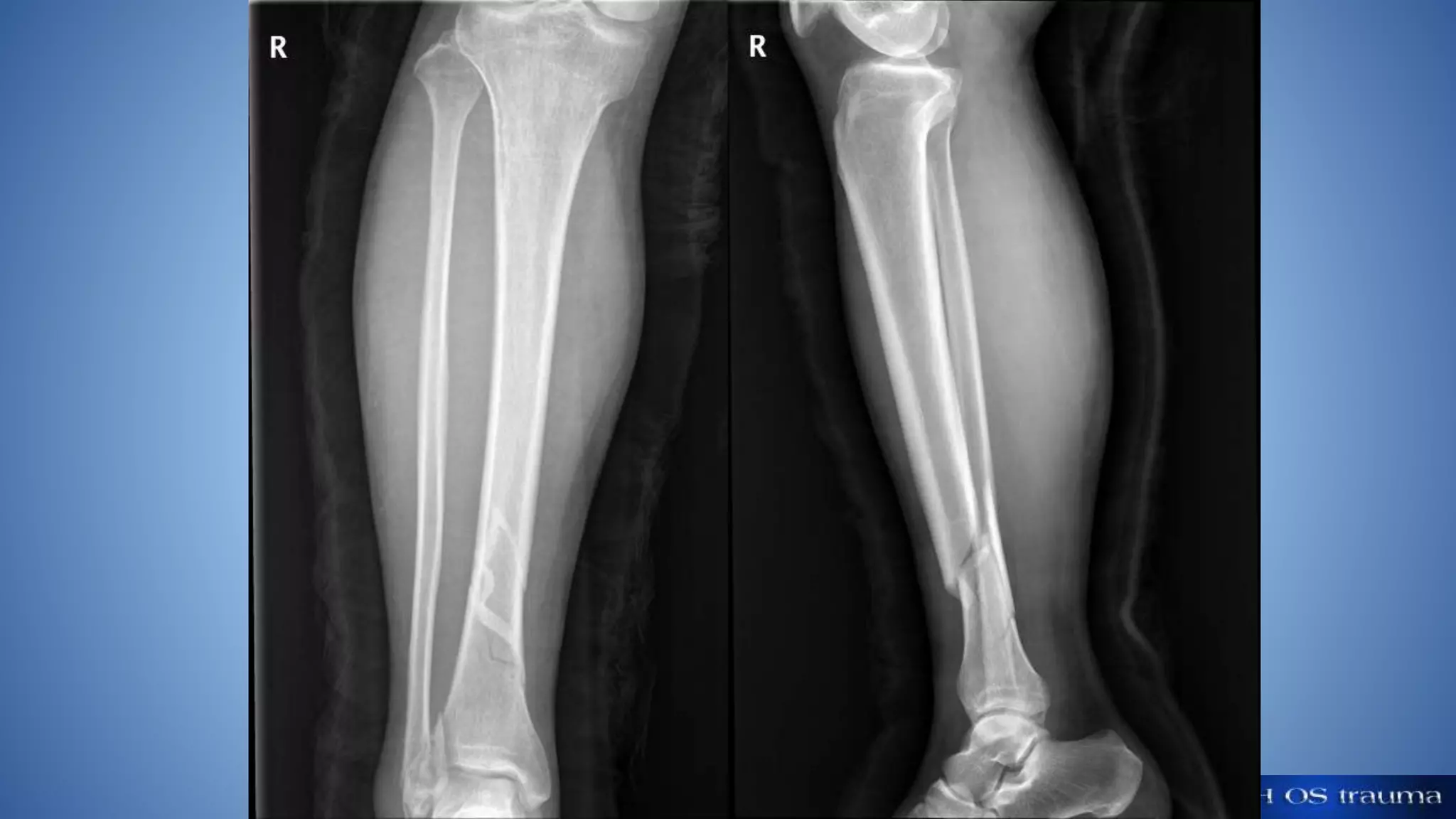 Tibia shaft OM | PPTX