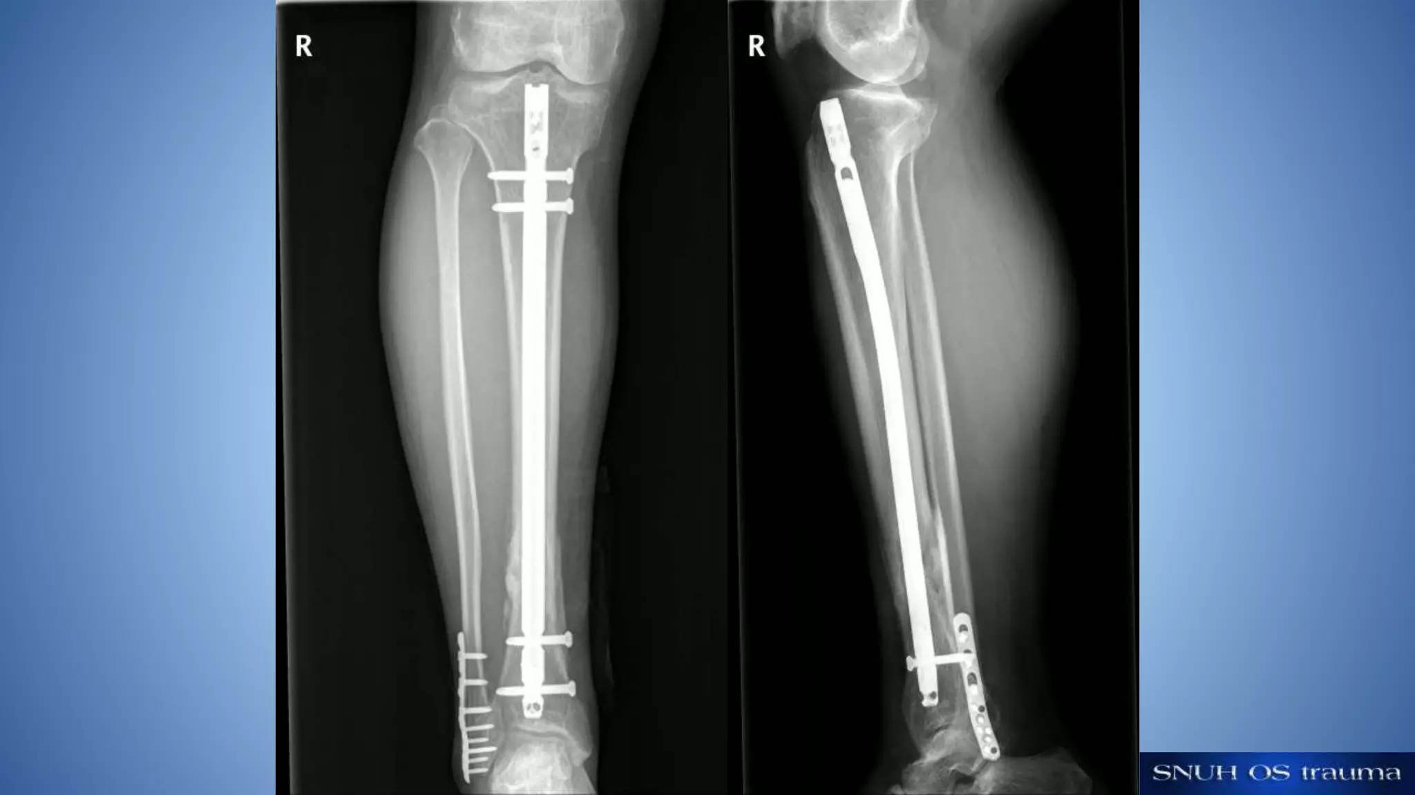 Tibia shaft OM | PPTX