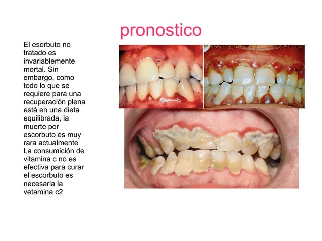 Escorbuto | ODP | Nutrition | Healthy Living