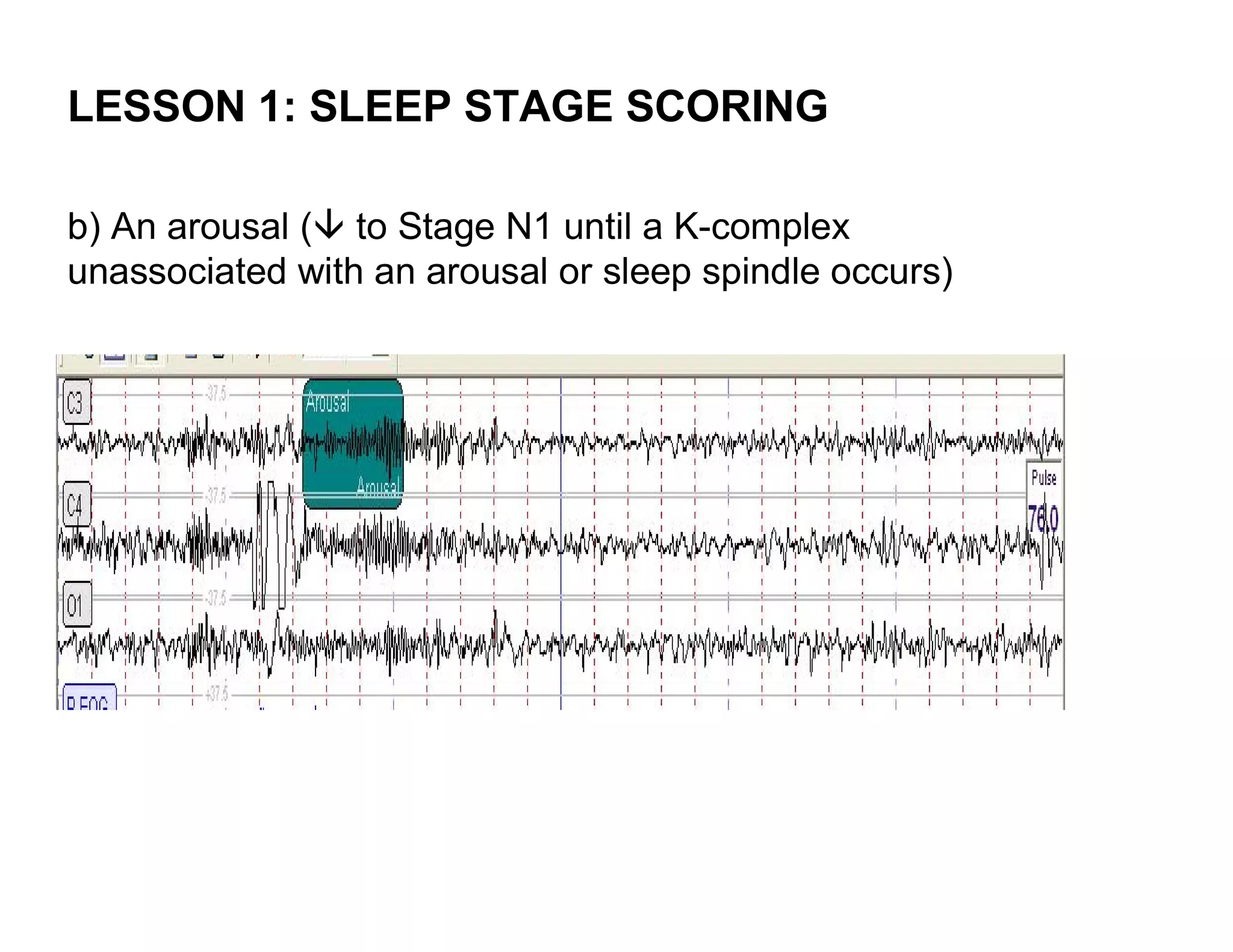 Scoring sleep 2013 webinar n2sleep | PDF