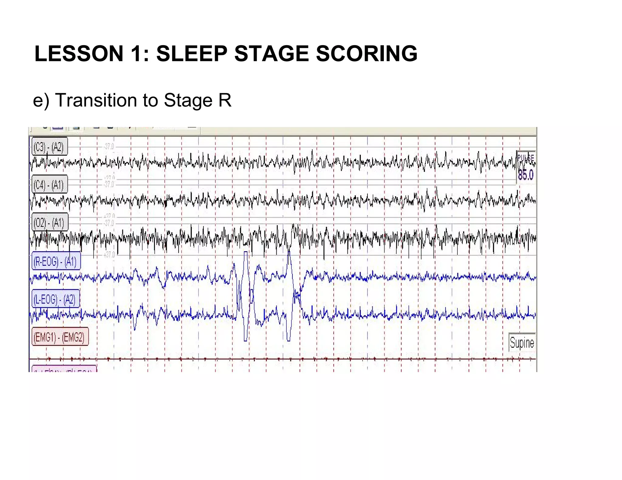 Scoring sleep 2013 webinar n2sleep | PDF