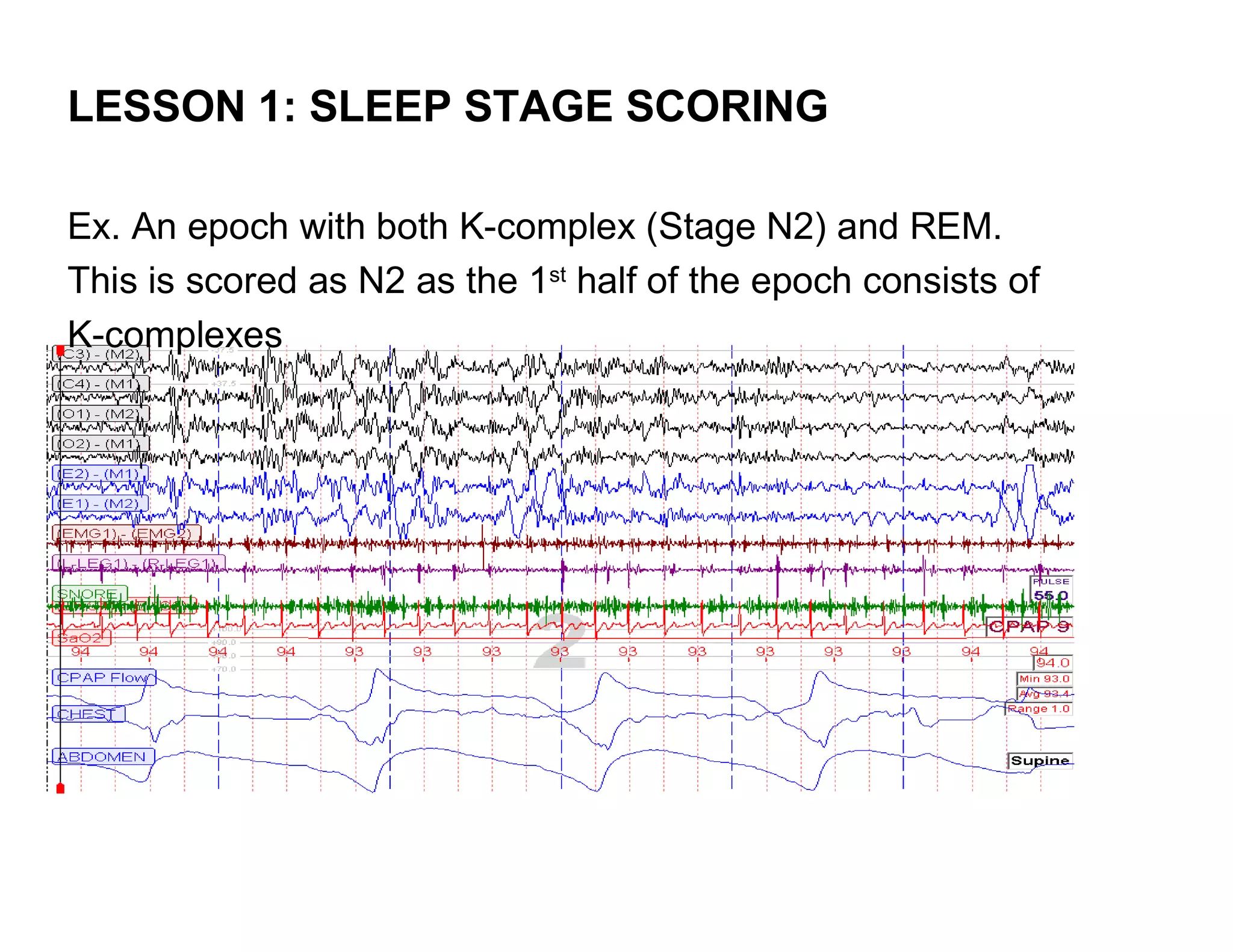 Scoring sleep 2013 webinar n2sleep | PDF