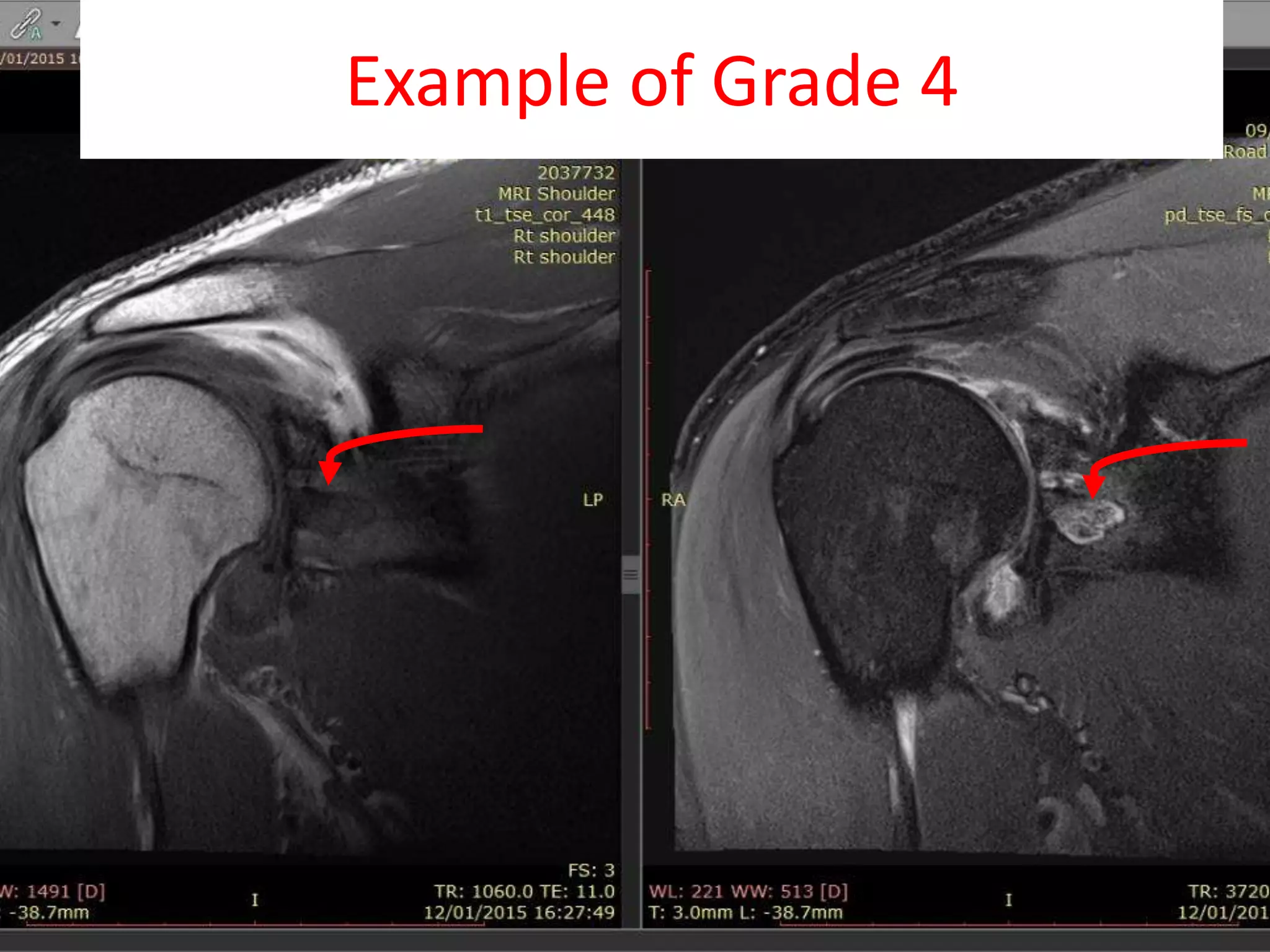 Bone Response to Suture Anchor Classification Training Document | PPT