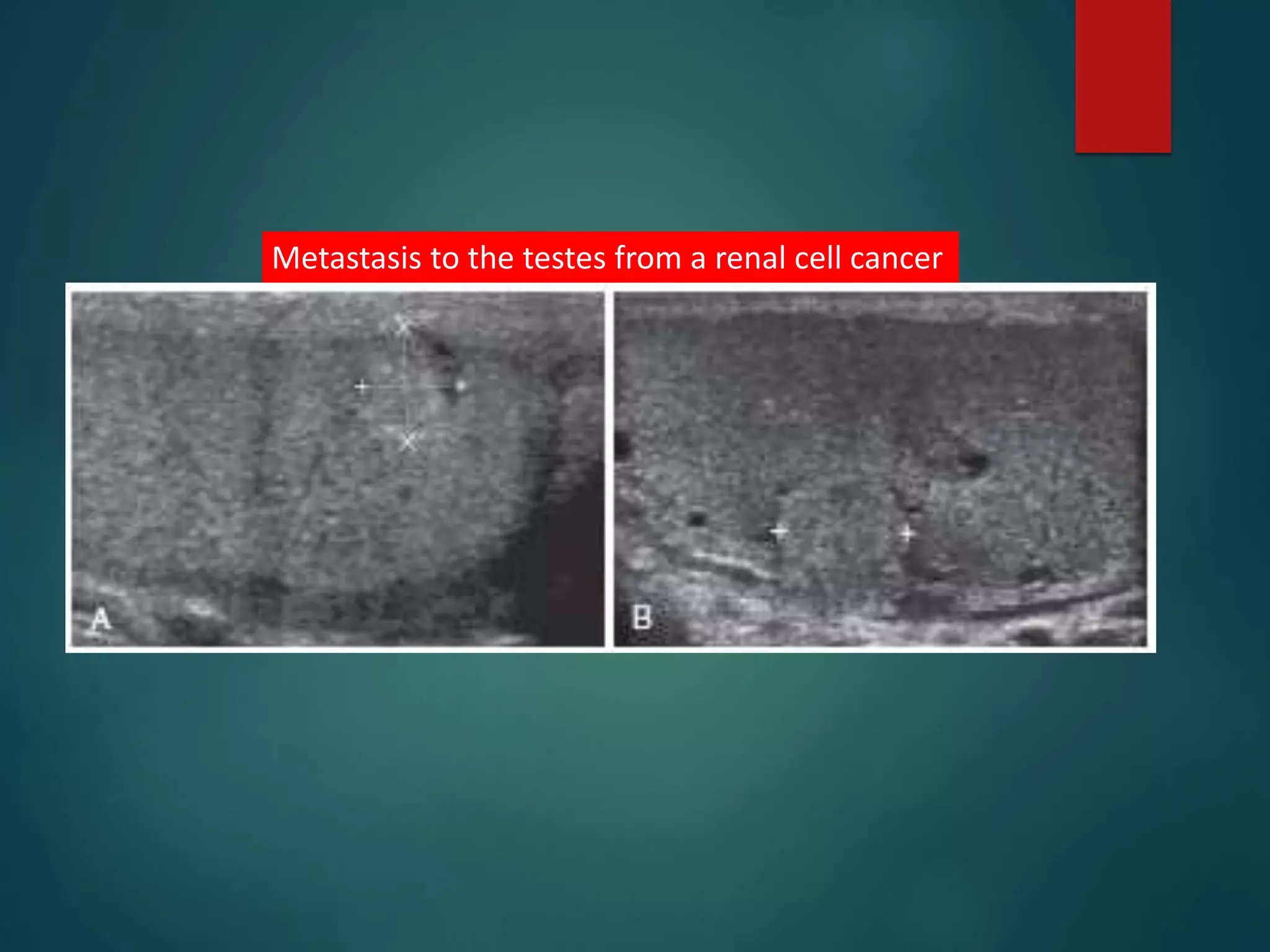 Scortal Ultrasound | PPTX