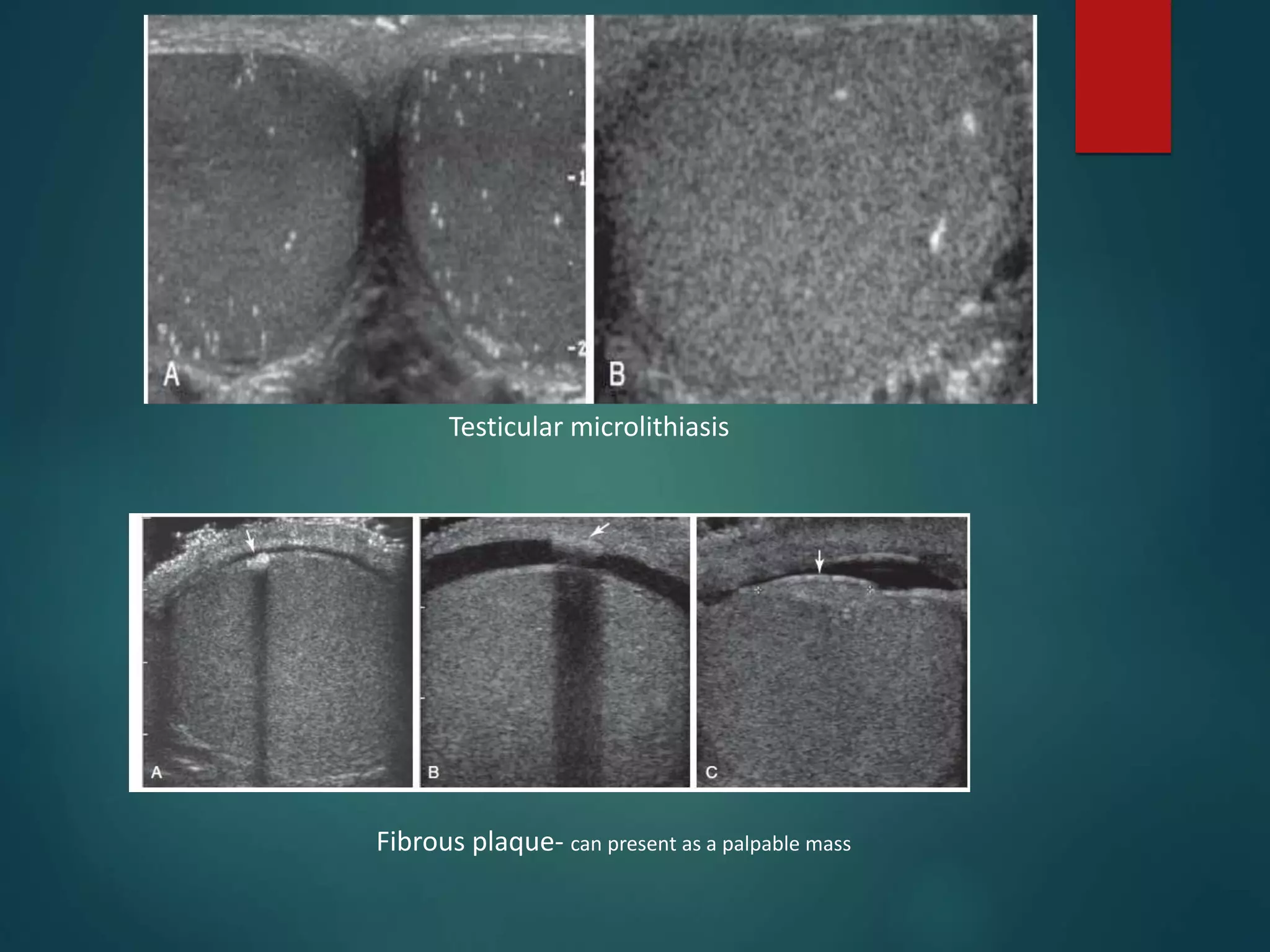 Scortal Ultrasound | PPTX