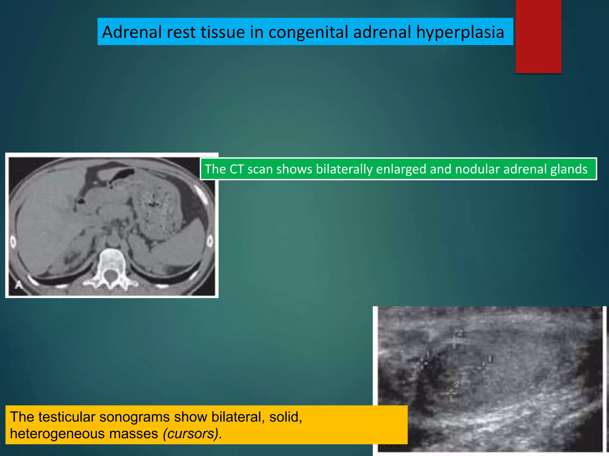Scortal Ultrasound | PPTX