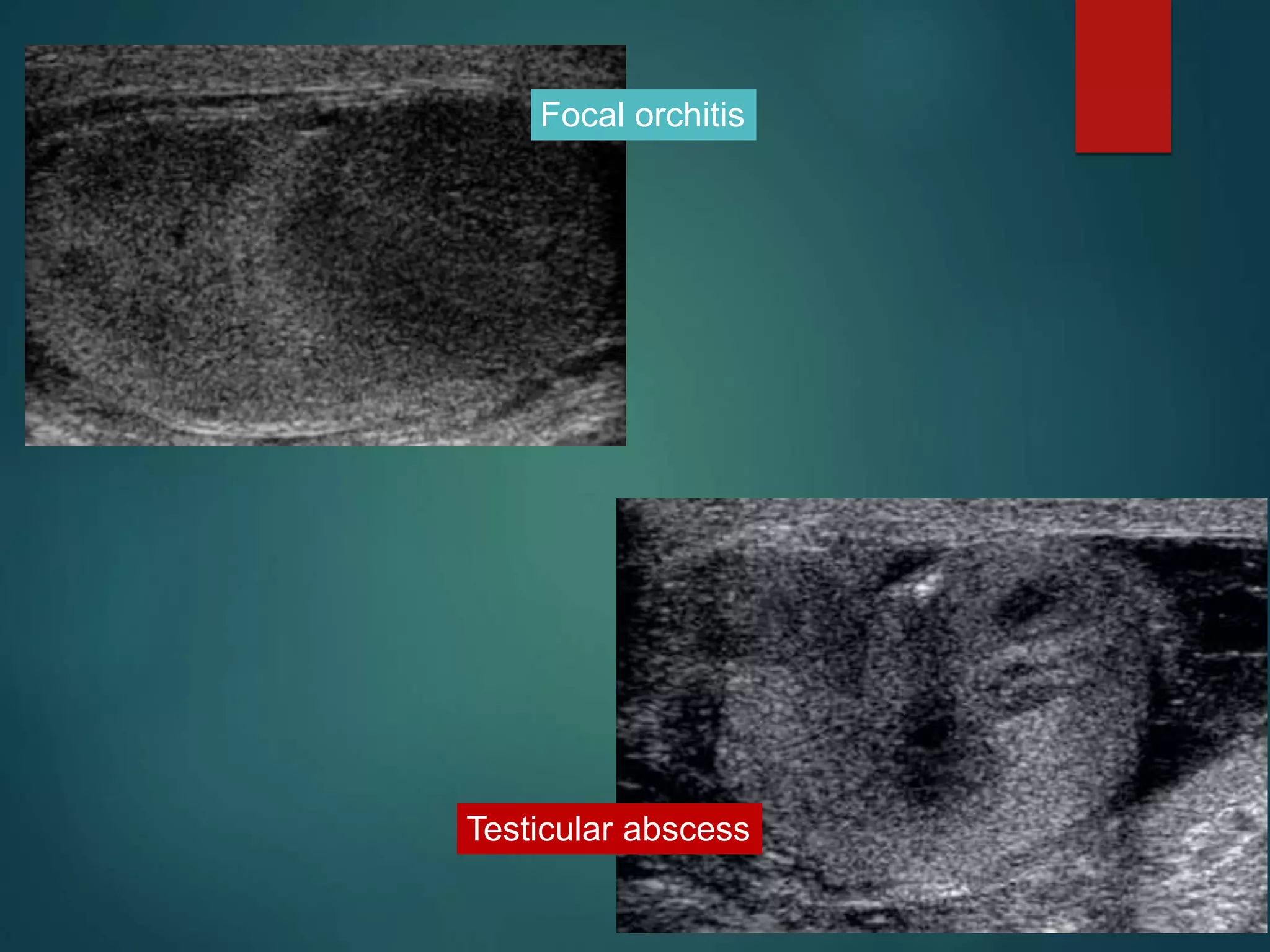 Scortal Ultrasound | PPTX