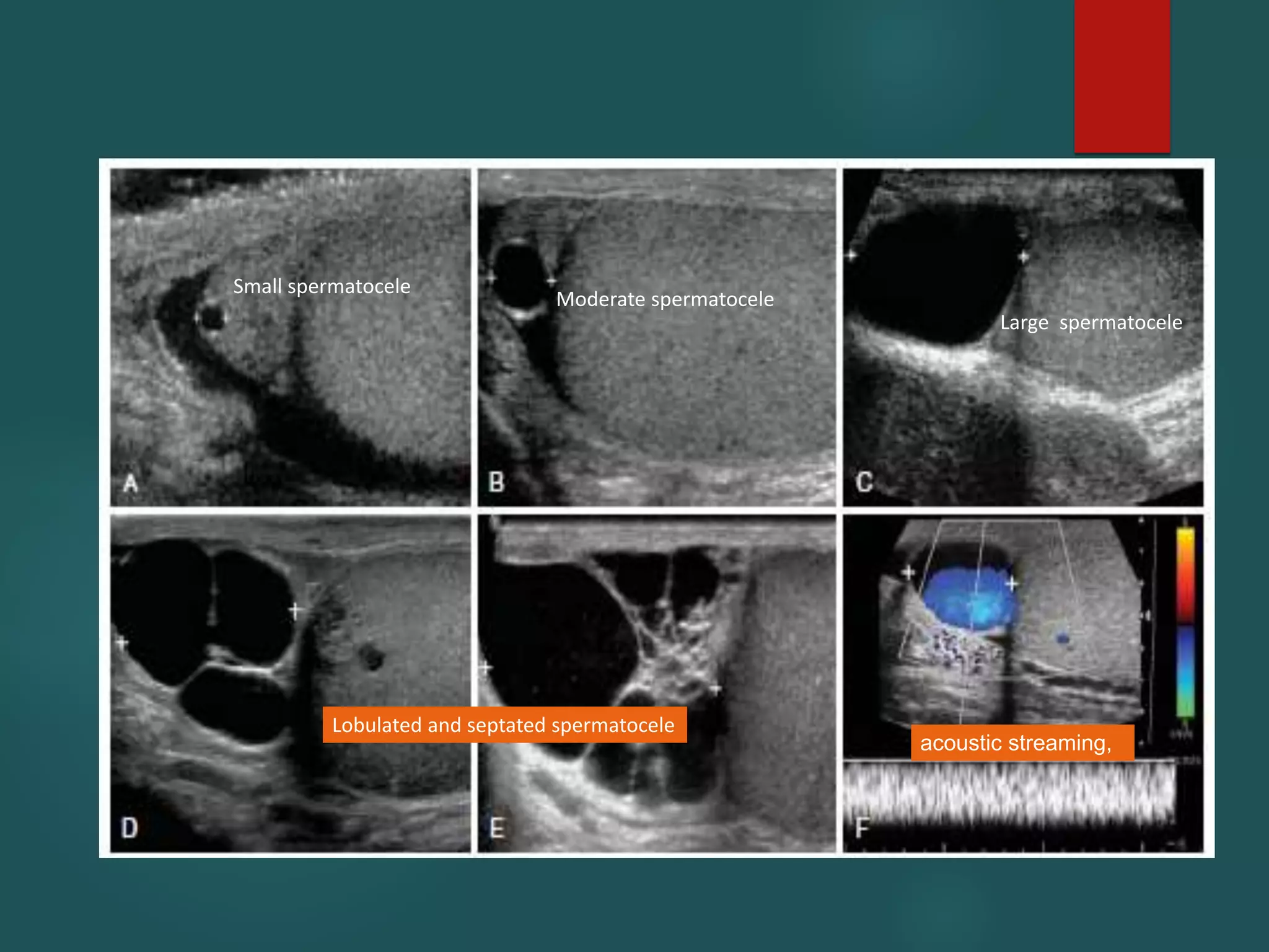 Scortal Ultrasound | PPTX
