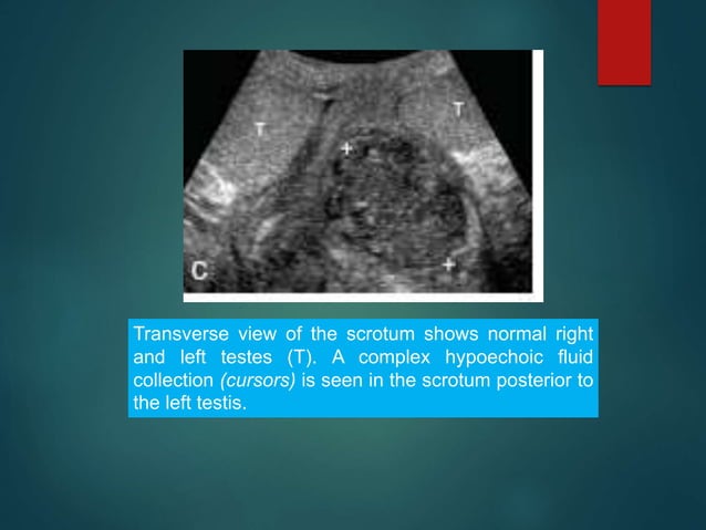 Scortal Ultrasound | PPT