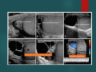 Scortal Ultrasound | PPTX