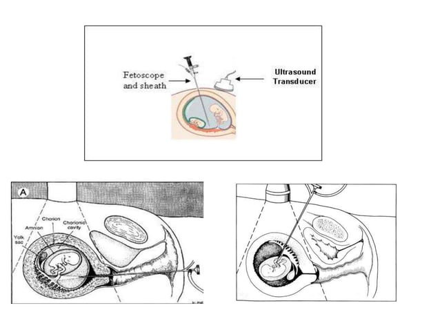 Screening of high risk pregnancy | PPTX