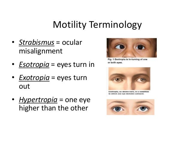 Exotropia Eyes Memes