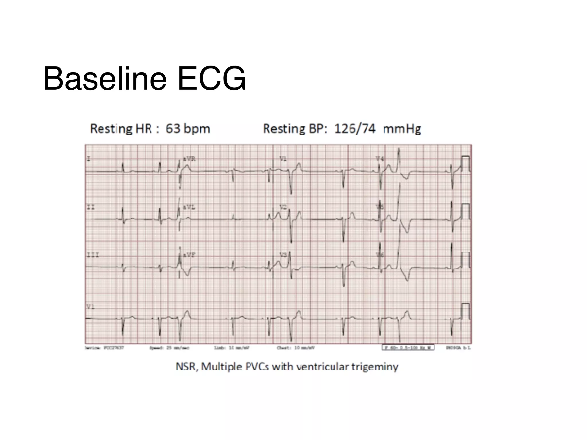 Cardiac Stress Test vs CT Coronary Angiogram: Which is better? | PDF
