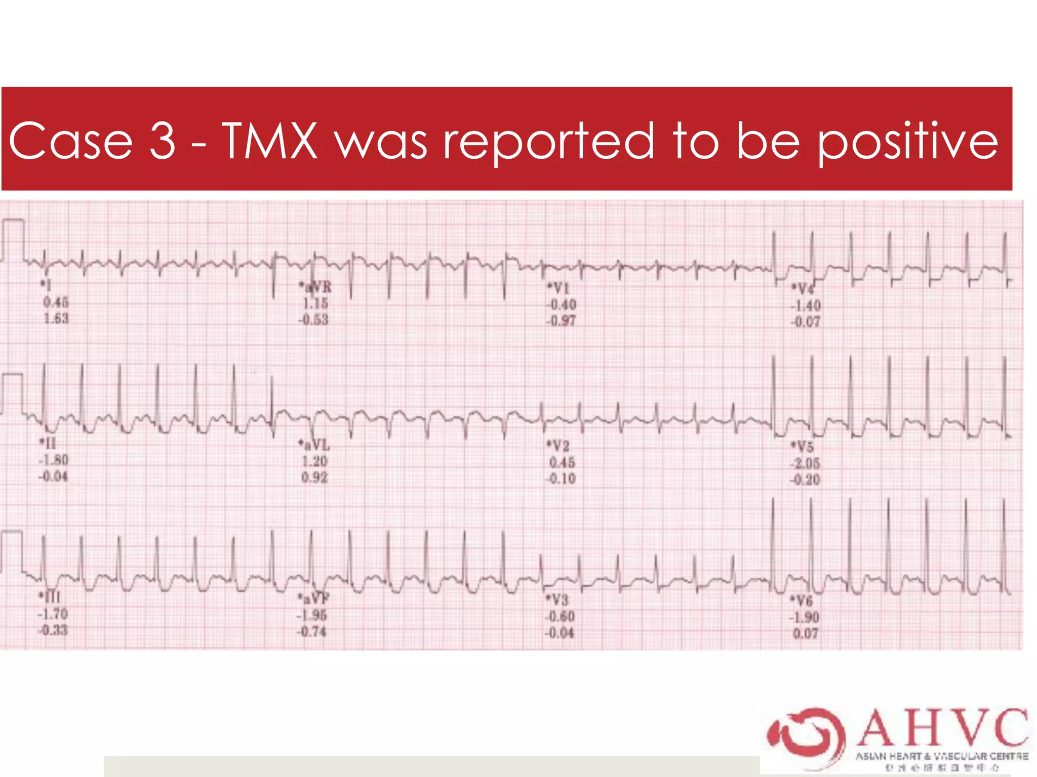 Cardiac Stress Test vs CT Coronary Angiogram: Which is better? | PDF