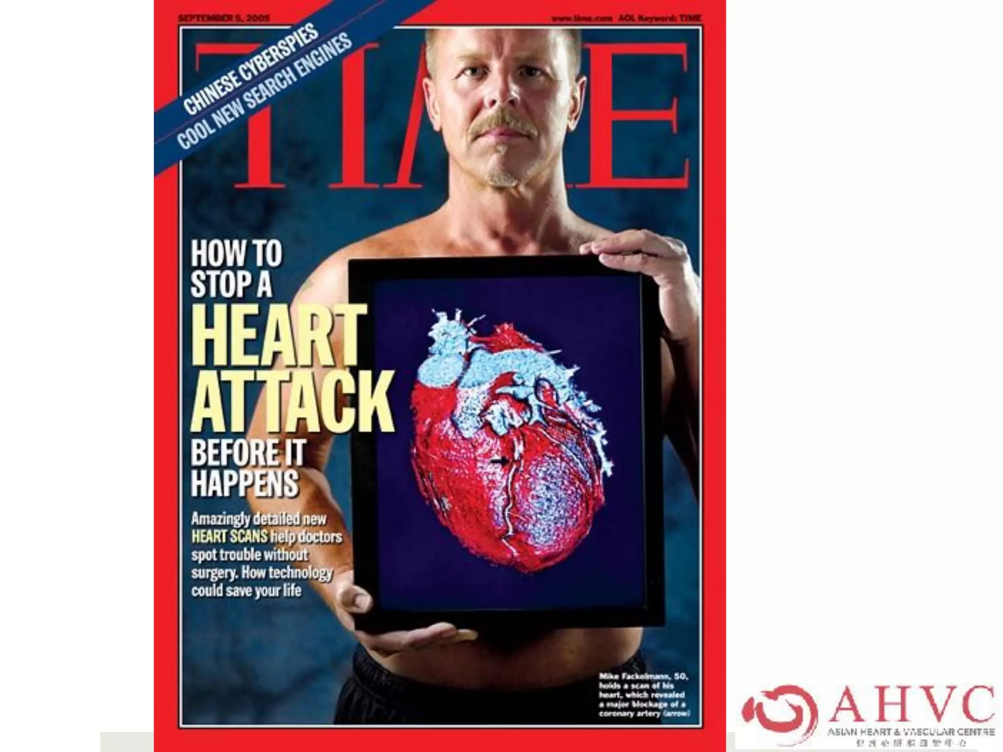 Cardiac Stress Test vs CT Coronary Angiogram: Which is better? | PDF