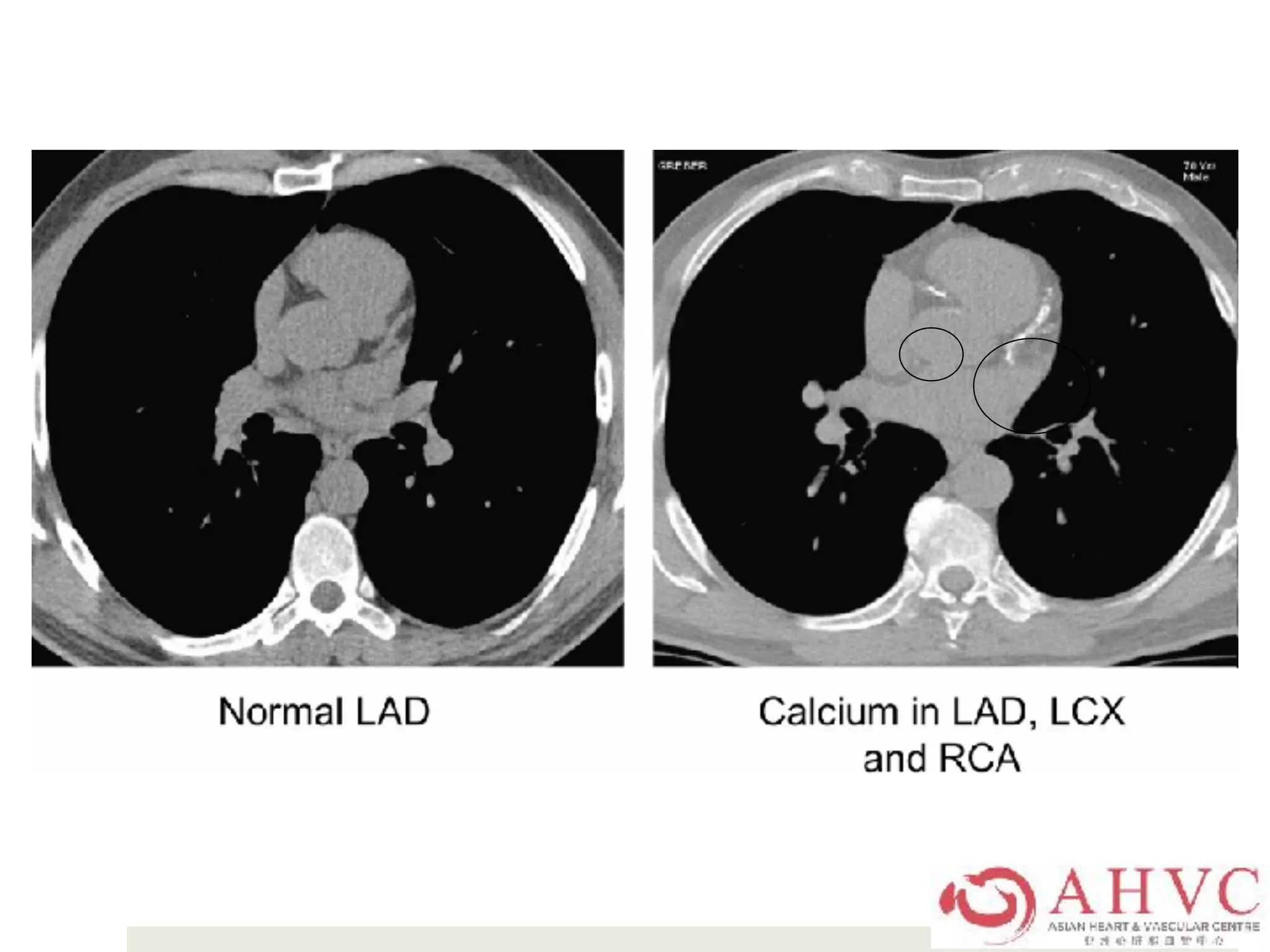 Cardiac Stress Test vs CT Coronary Angiogram: Which is better? | PDF