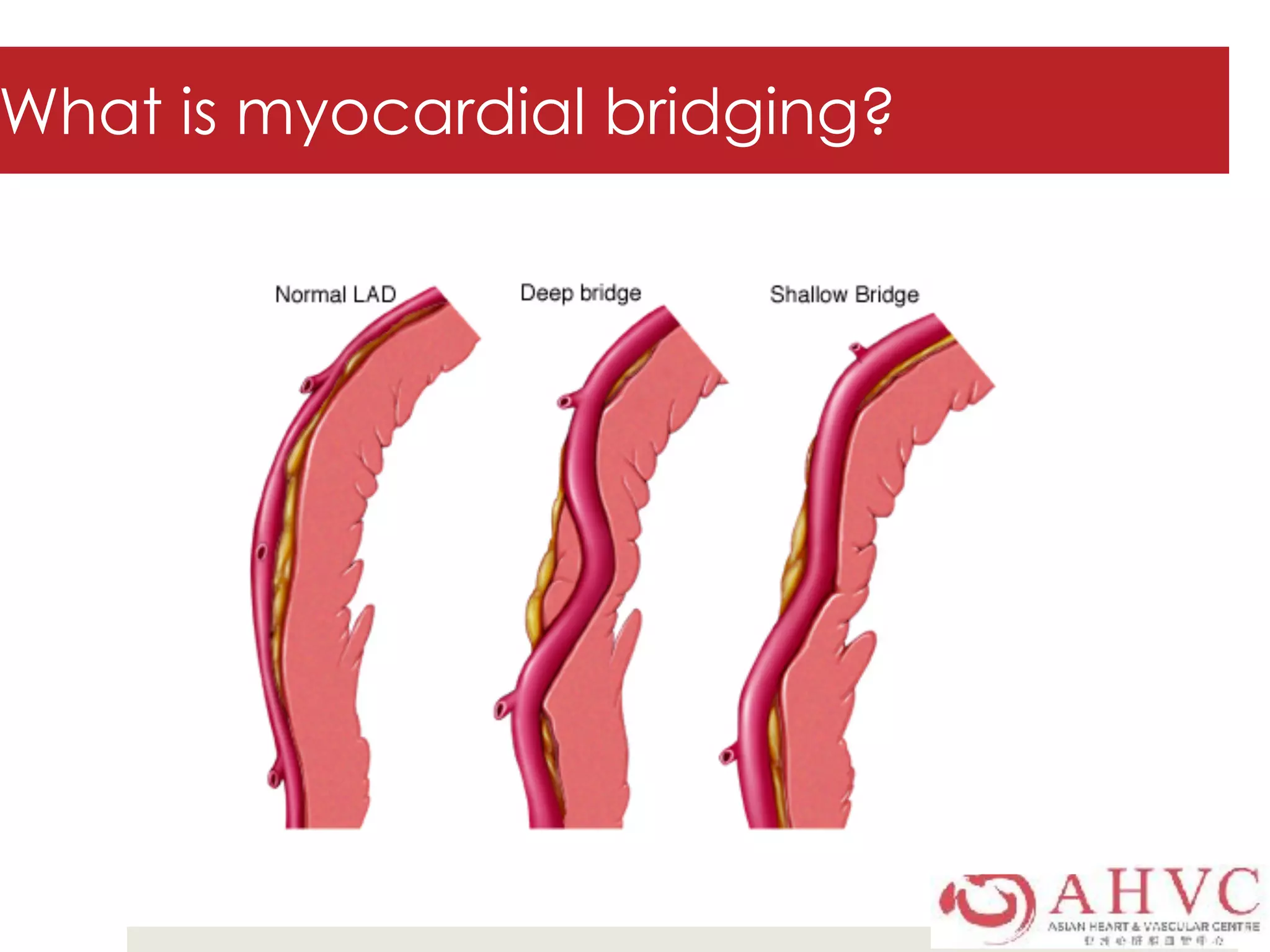 Cardiac Stress Test vs CT Coronary Angiogram: Which is better? | PDF
