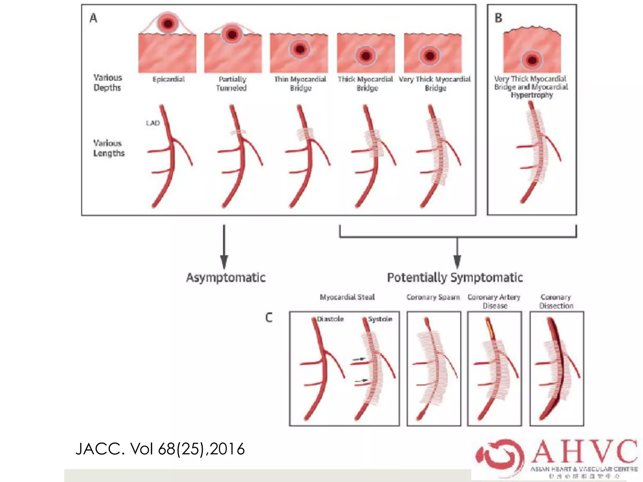 Cardiac Stress Test vs CT Coronary Angiogram: Which is better? | PDF