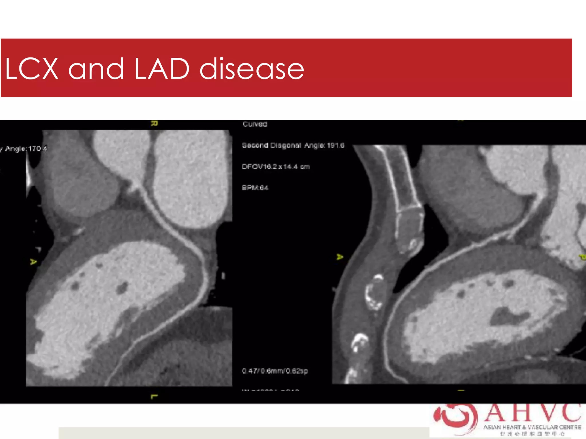 Cardiac Stress Test vs CT Coronary Angiogram: Which is better? | PDF