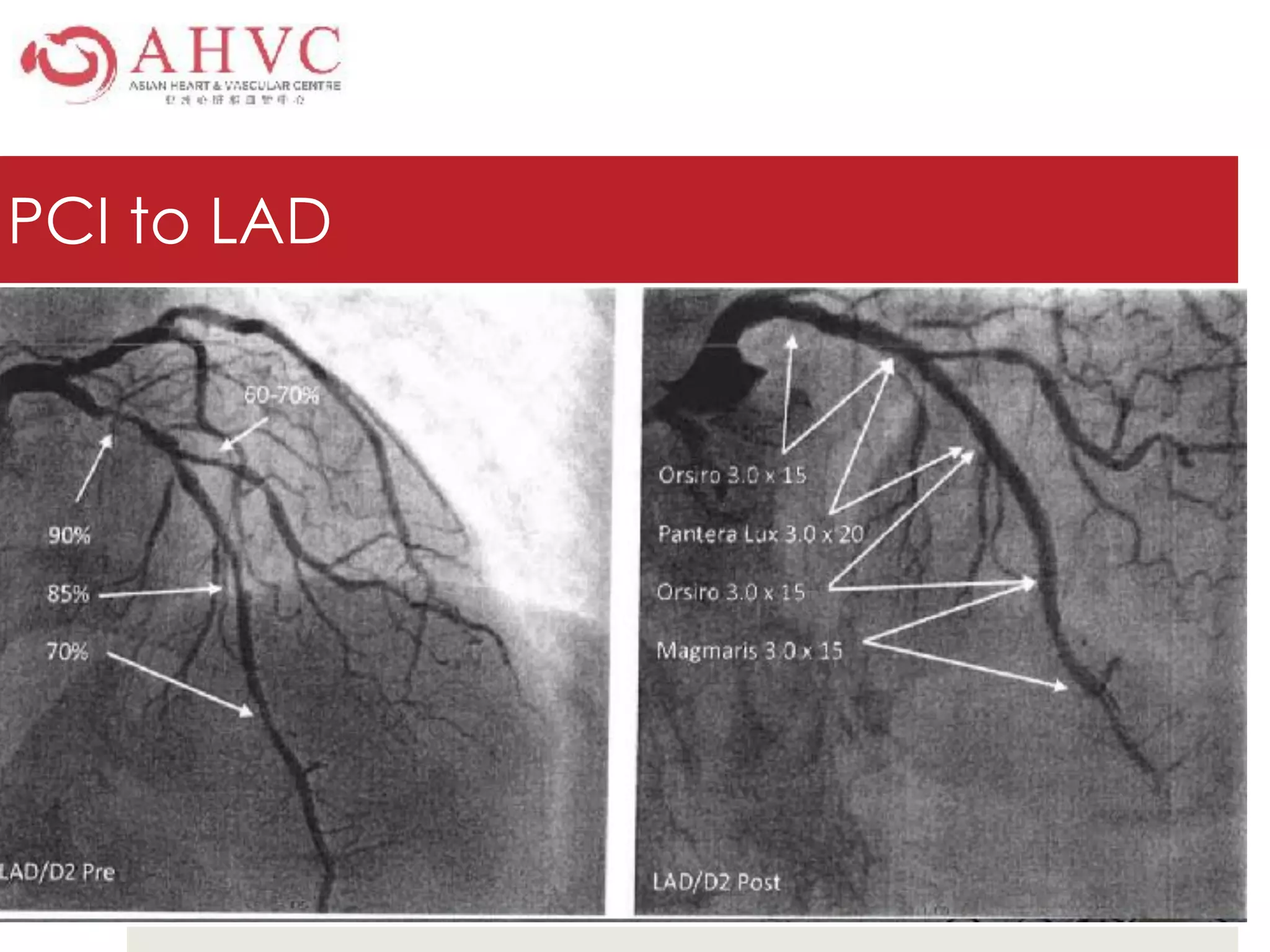 Cardiac Stress Test vs CT Coronary Angiogram: Which is better? | PDF