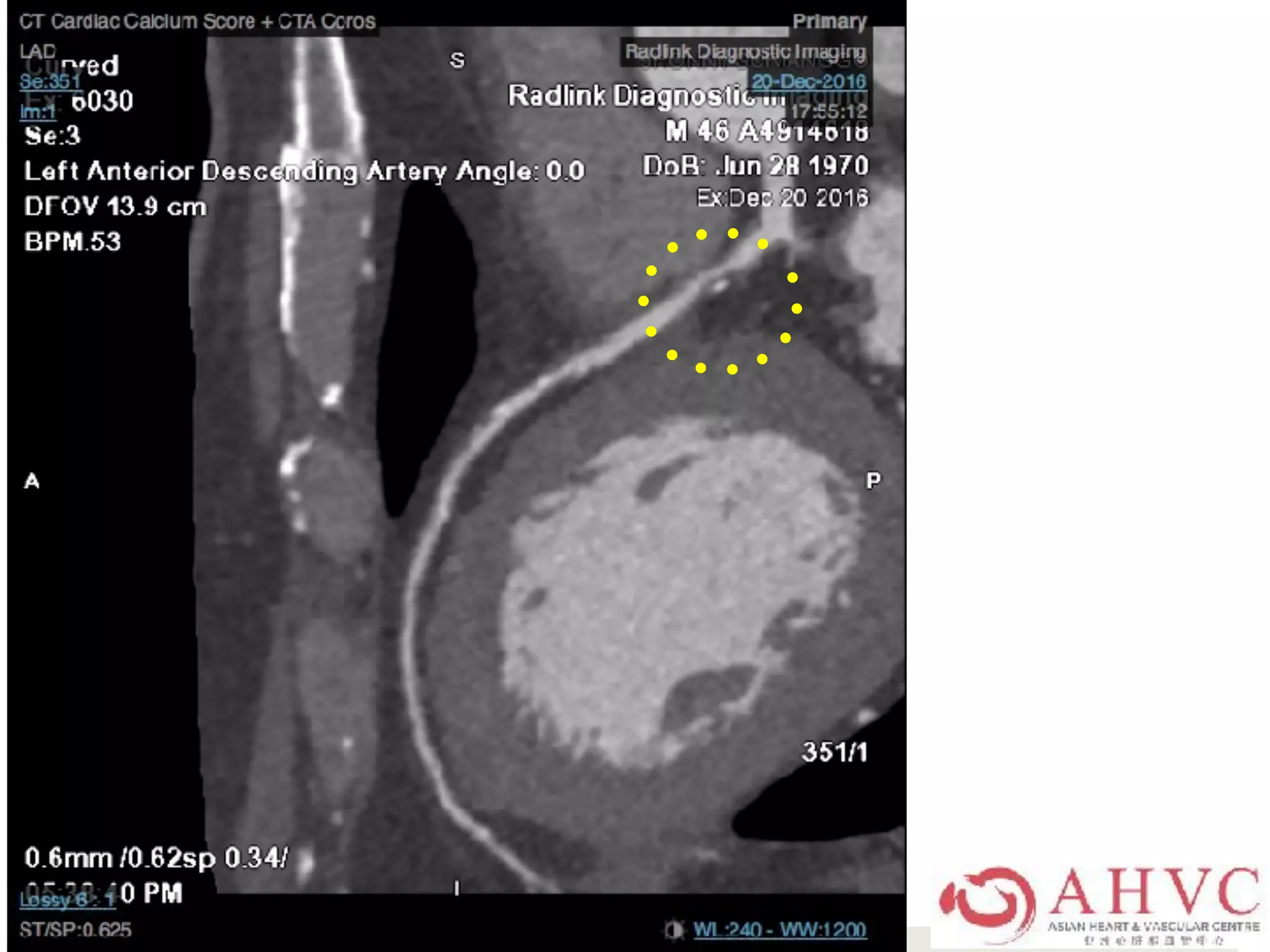 Cardiac Stress Test vs CT Coronary Angiogram: Which is better? | PDF