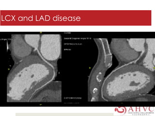 Cardiac Stress Test vs CT Coronary Angiogram: Which is better? | PDF