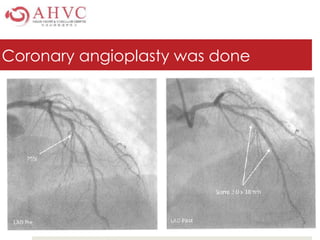 Cardiac Stress Test vs CT Coronary Angiogram: Which is better? | PDF