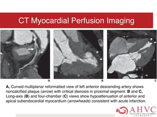Cardiac Stress Test vs CT Coronary Angiogram: Which is better? | PDF