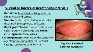 Conjunctivitis I Screening I Management I | PPT