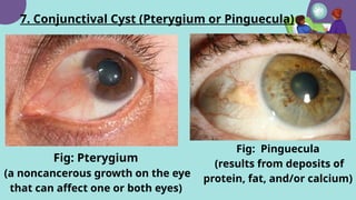 Conjunctivitis I Screening I Management I | PPT
