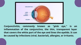 Conjunctivitis I Screening I Management I | PPTX