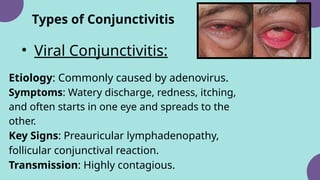 Conjunctivitis I Screening I Management I | PPTX