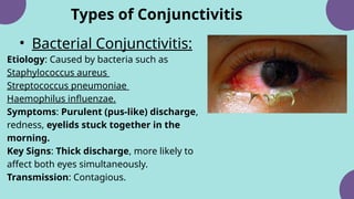 Conjunctivitis I Screening I Management I | PPT