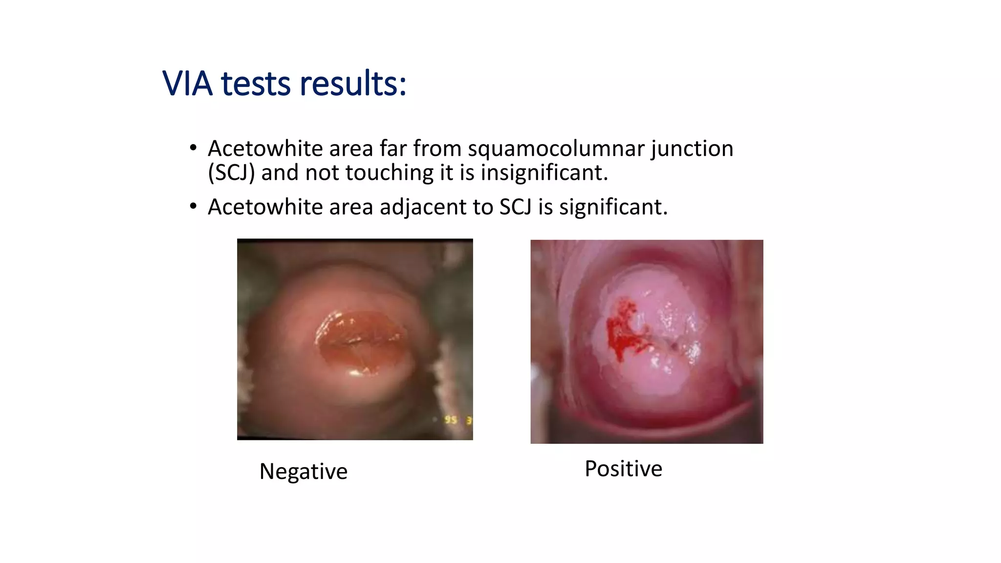 Cervical Cancer Screening Modalities | PPTX
