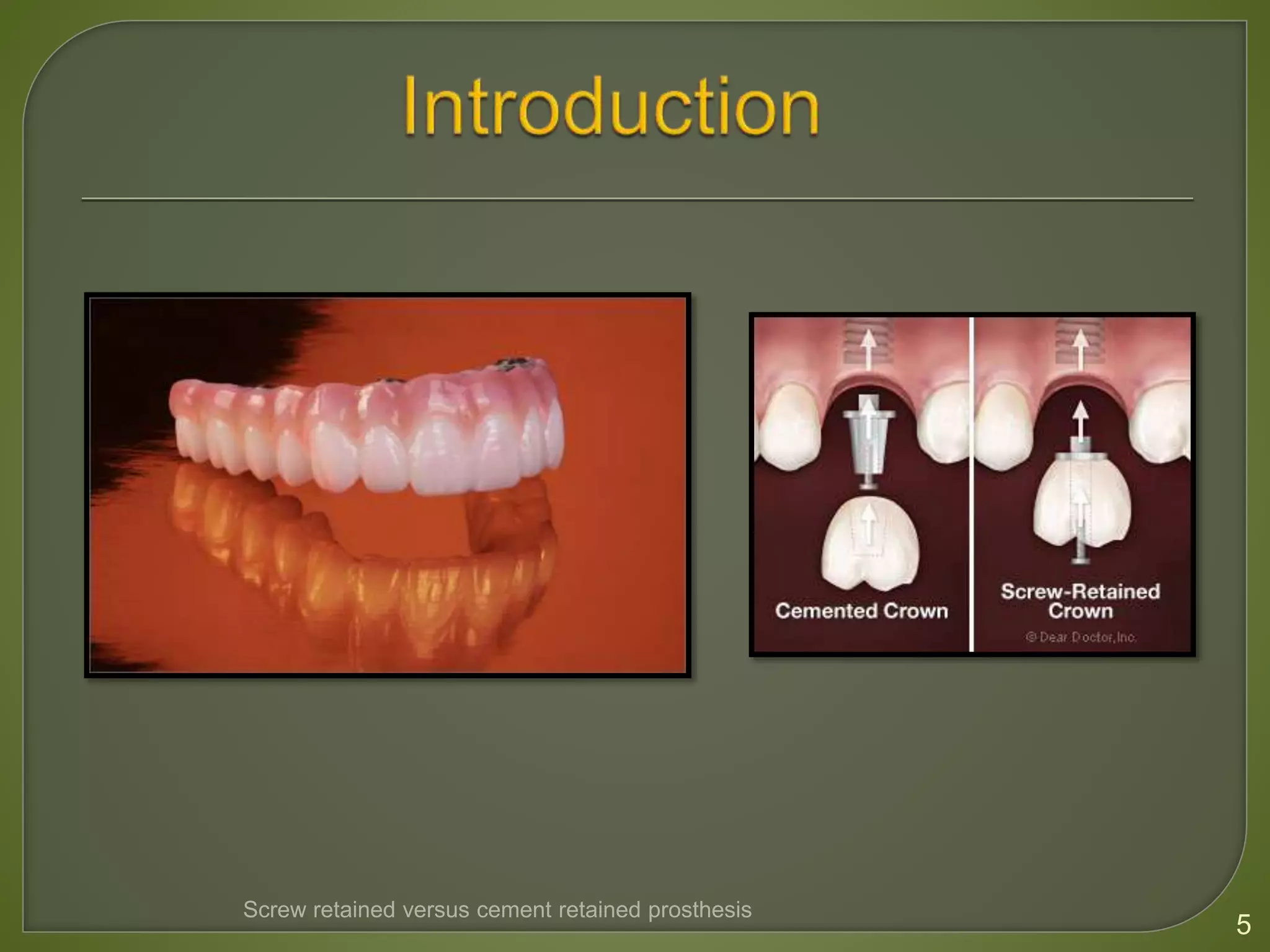 Screw retained vs cement retained prosthesis.pptx