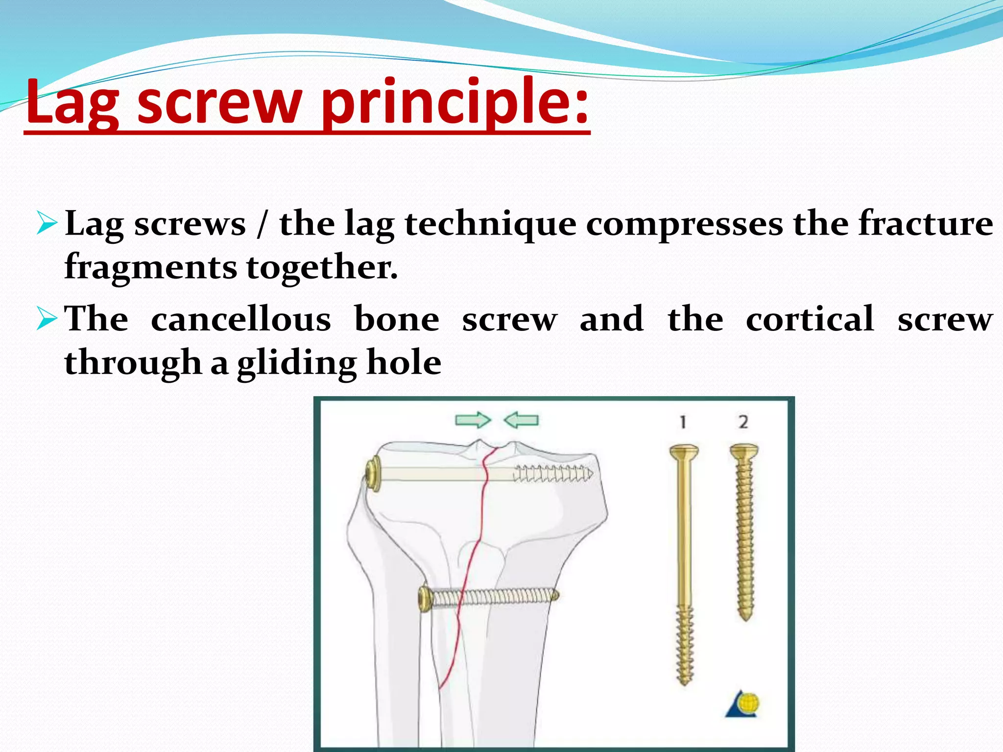 SCREWS in orthopaedic surgery.pptx