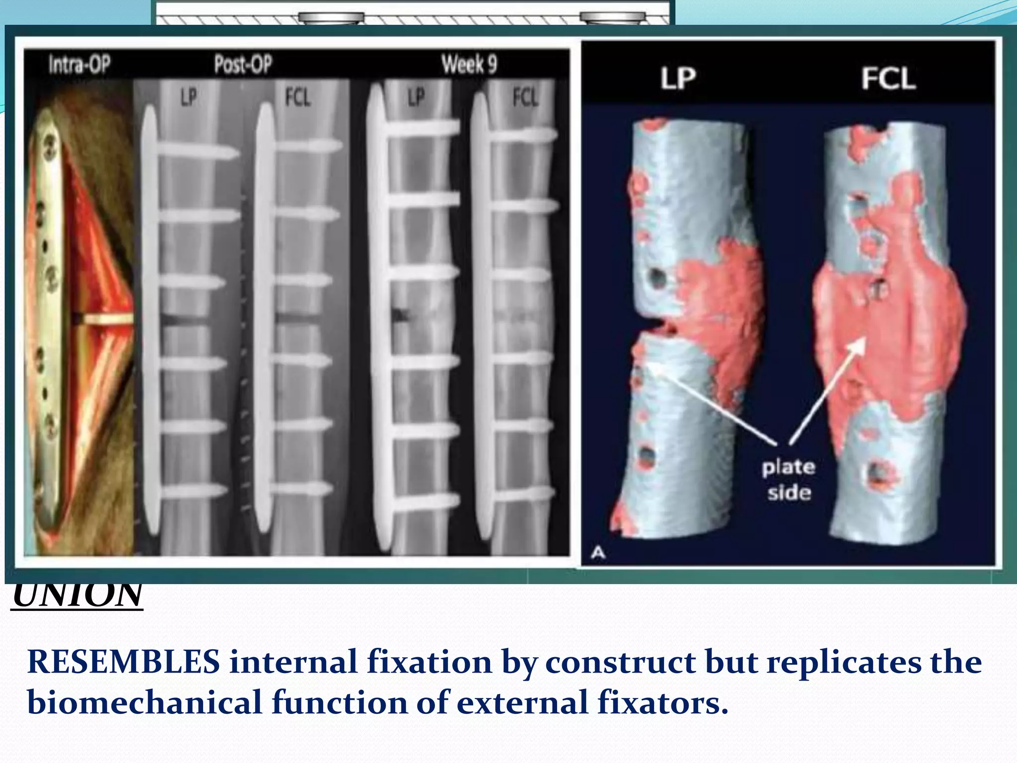 SCREWS in orthopaedic surgery.pptx